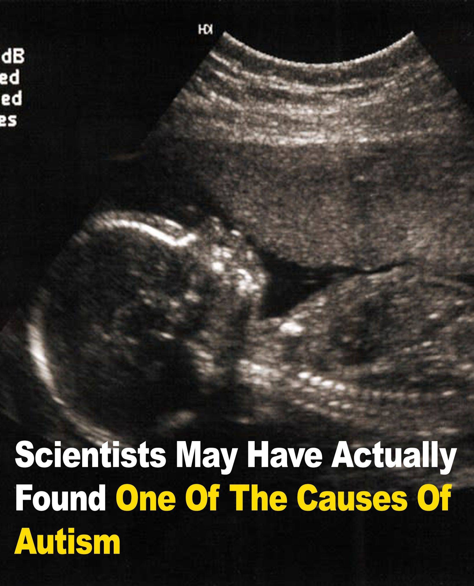 Scientists May Have Actually Found One Of The Causes Of Autism ...